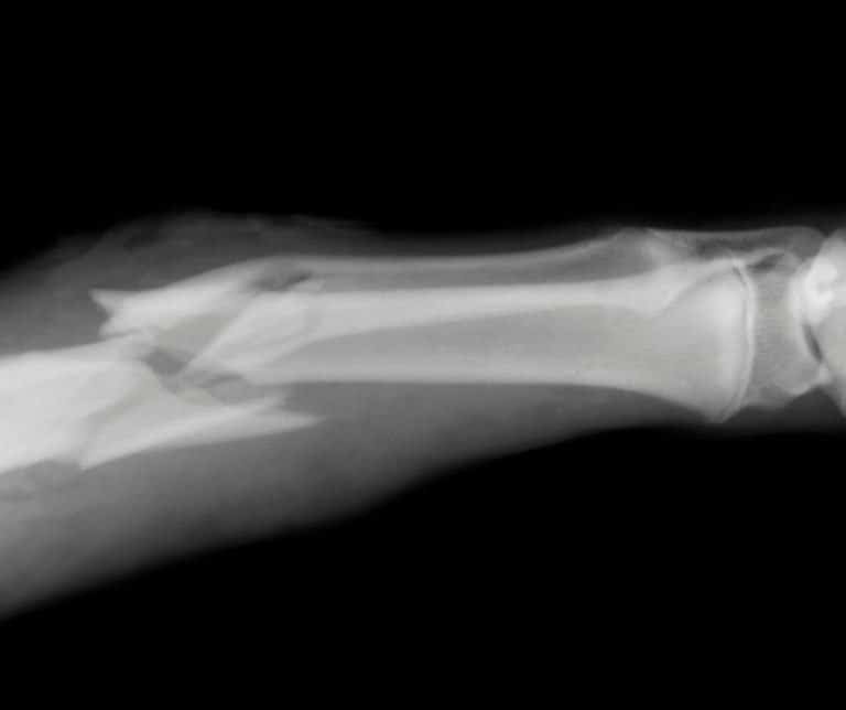 Four Stages of Bone Fracture Healing